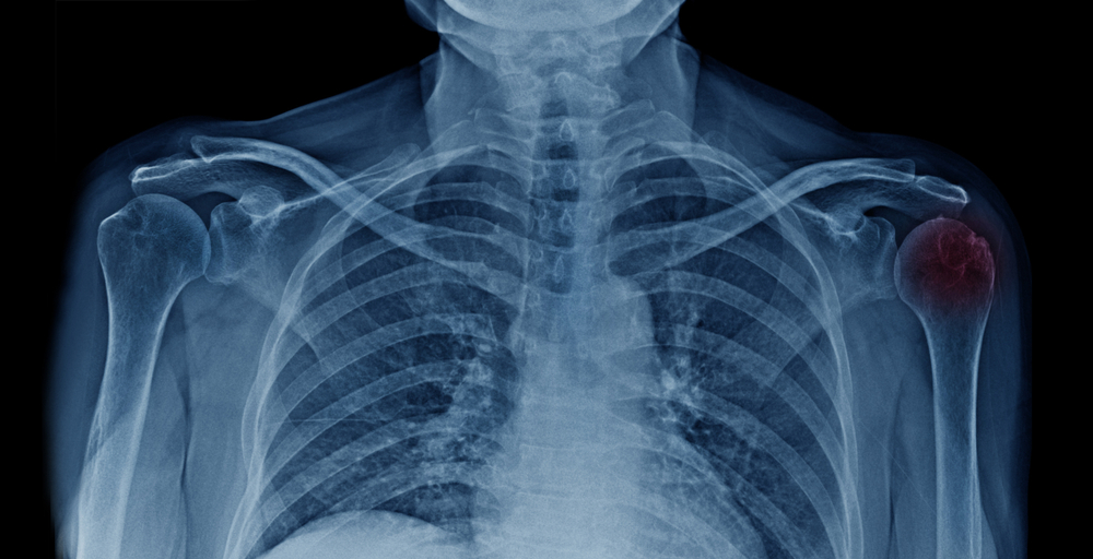 Cirurgia de bursite no ombro: como é feita? - Dr. Rodolpho Scalize